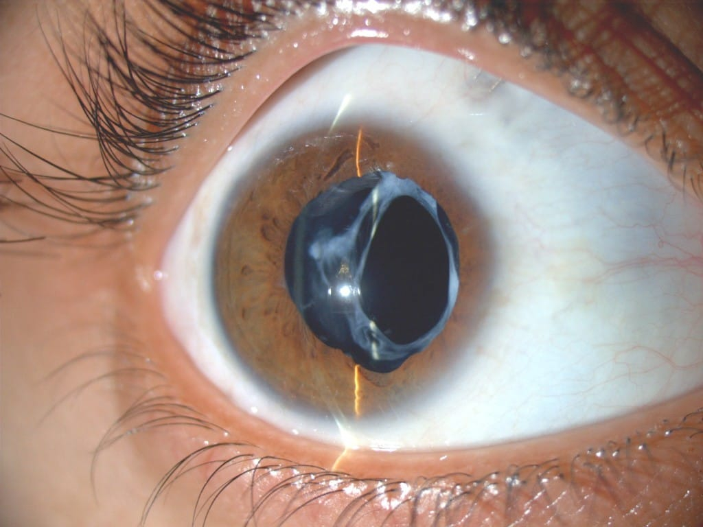 PCO Amritsar Eye Clinic