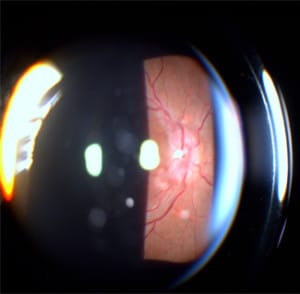 Optic_disc_swelling - Amritsar Eye Clinic