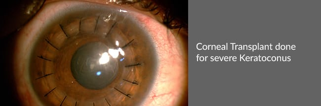Keratoconus Amritsar Eye Clinic